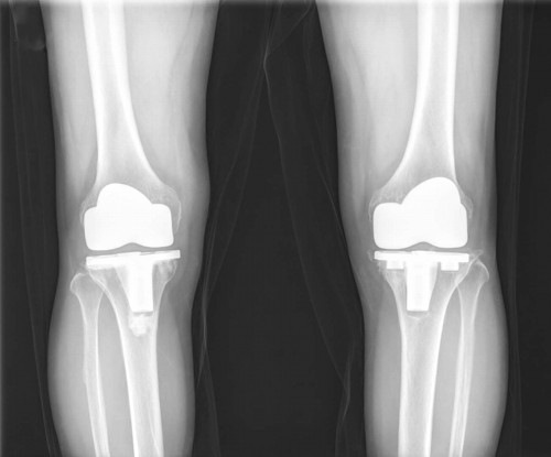 Sa është përqindja e përgjithshme e vdekshmërisë në protezat e gjurit ...