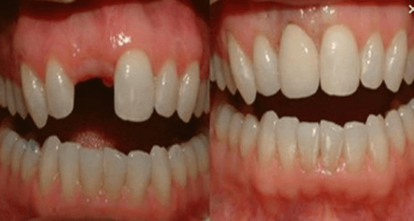 Ja si mund të rrisni dhëmbin e humbur për 9 javë! – GAZETA SHËNDETI