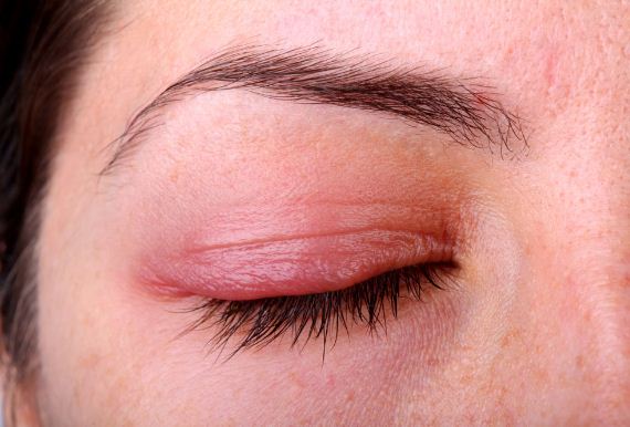 A e dëmton shikimin herpesi i syrit? – GAZETA SHËNDETI